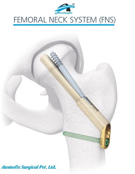 Titanium Austeofix Femoral Neck System Size 1 Hole And 2 Hole At Best