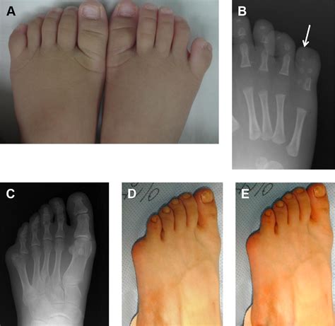 Congenital Lesser Toe Abnormalities Foot And Ankle Clinics