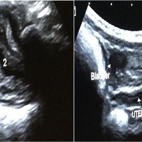 Mcug Micturating Cystourethrogram Showing Normal Bladder Shape With