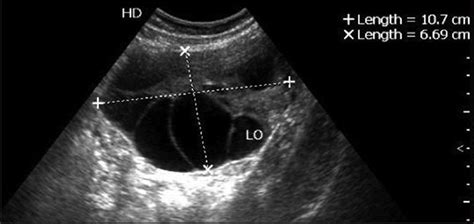 Hyperreactio Luteinalis An Often Mistaken Diagnosis Pmc