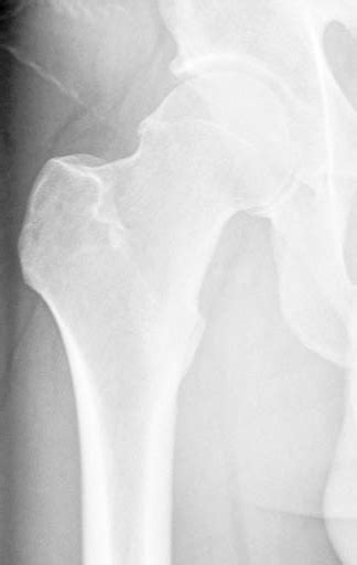 Hip Joint Detection Roboflow Universe