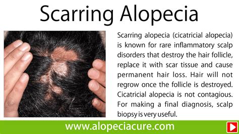 Scarring Alopecia Treatment Injections At Priscilla Scott Blog