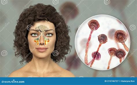 Aspergillus Fungi As A Cause Of Sinusitis Stock Illustration Illustration Of Treatment Adult