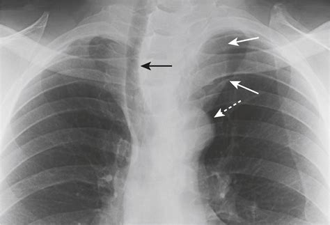 Recognizing Other Diseases Of The Chest Clinical Tree