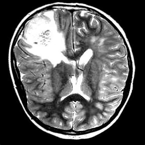 Brain Tumor Object Detection Object Detection Dataset By School Project