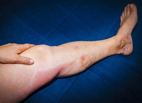 Lumps On Legs Symptoms Causes Diagnosis And Treatment