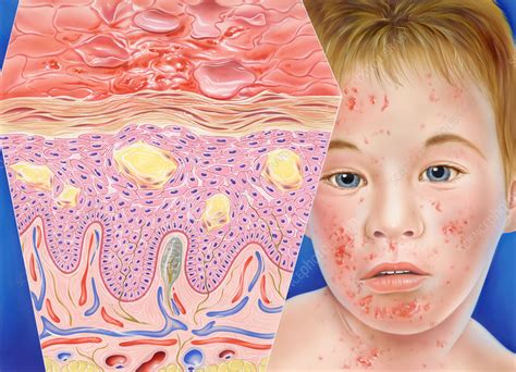Eczema Stock Image M1500229 Science Photo Library