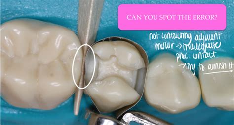 Op Ii Large Posterior Composite Restorations Flashcards Quizlet