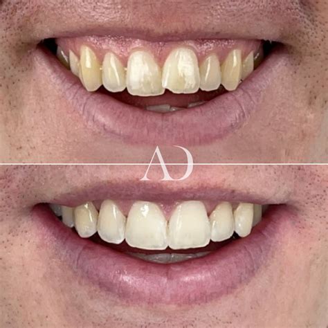 Wisdom Teeth Extraction Adore Dental