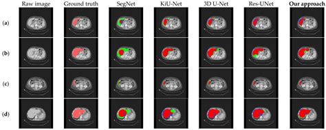 Dual Attention Based 3d U Net Liver Segmentation Algorithm On Ct Images