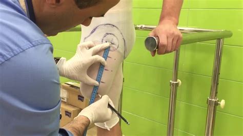 🙌Зняття мірок перед гіпсуванням. ⠀ 👉По майбутній гіпсовій моделі ми ...