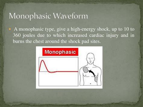 Biphasic And Monophasic Defibrillation Waveforms At Ruth Tovar Blog