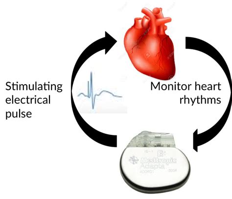 Heart Pacemaker Feedback To Improve Heart Regulation Braintrainuk