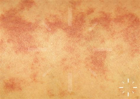 Dermacompass Urticarial Vasculitis