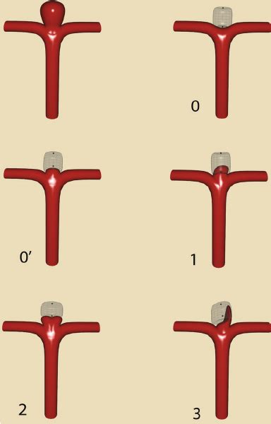 Web Occlusion Scale Grade 0 Indicates Complete Occlusion Grade 0 Ј Is