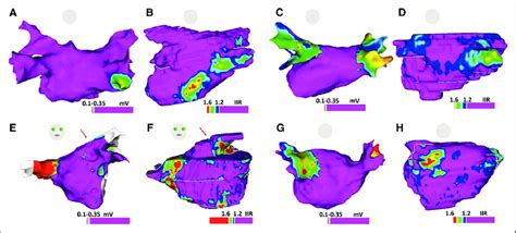 Comparison Of Atrial Substrate On Electroanatomic Voltage Map And Late Download Scientific