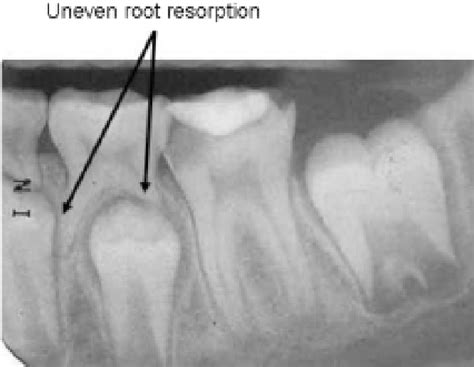 Figure 3 From Physiologic Root Resorption In Primary Teeth Molecular