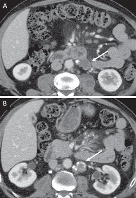 Tuberculous Lymph Node Disease In A 54 Year Old Male Patient Presence Download Scientific