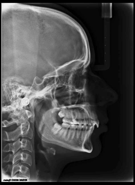 Cephalometric Radiograph Of A Patient With Skeletal Class Ii Download Scientific Diagram