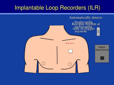 Ppt Diagnosis And Management Of Syncope Powerpoint Presentation Free