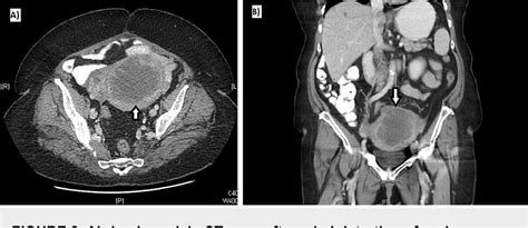 Figure 2 From Uterine Primitive Neuroectodermal Tumor Semantic Scholar