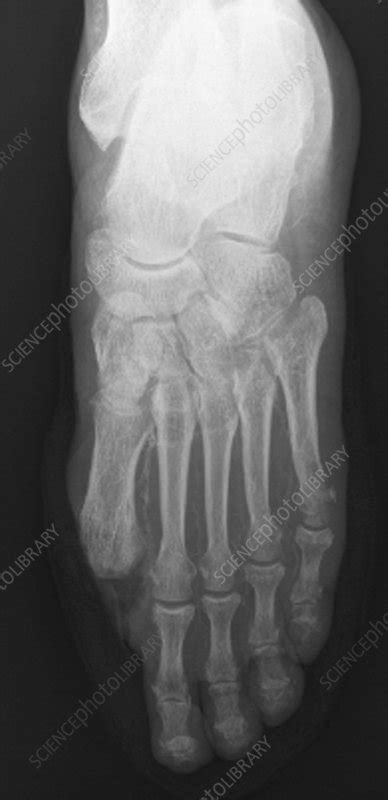 Toe Amputation In Diabetes X Ray Stock Image C007 1979 Science Photo Library