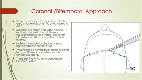 Extraoral Surgical Approaches To Temporomandibular Joint Pdf