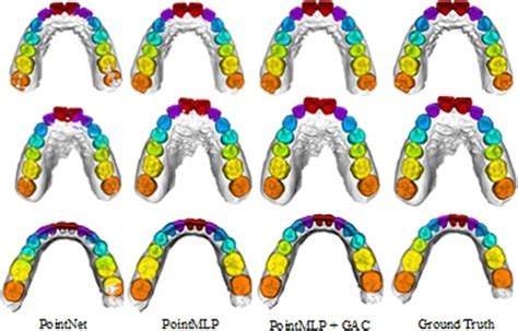 Full Article The 3d Tooth Model Segmentation Method Based On Gac