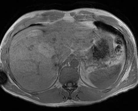 Liver Atlas Diagnosis Steatosis Steatohepatitis