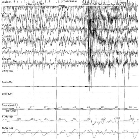 Polysomnographic Demonstration Of Confusional Arousal Occurring Out Of Download Scientific