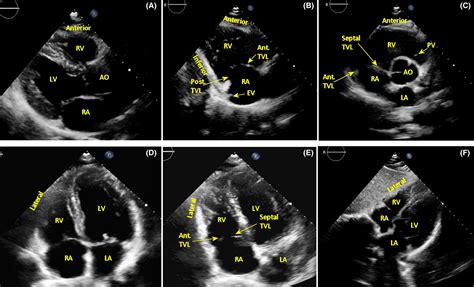 Arrhythmogenic Right Ventricular Dysplasia Echo