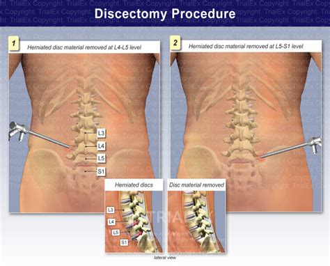 Discectomy Procedure