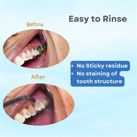Hemostatic And Retraction Gel For Dental Procedures Hsr Gel Bhoojaa