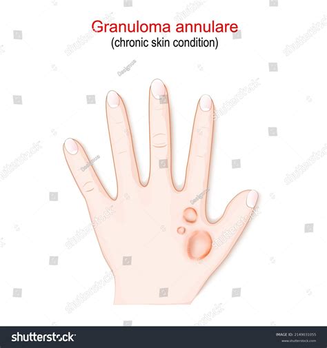 29 張 Annular Rash 圖片、庫存照片和向量圖 Shutterstock