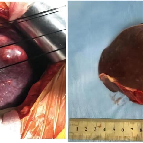 Left Hepatectomy Was Conducted And A Single Exophytic Nodule Was Download Scientific Diagram