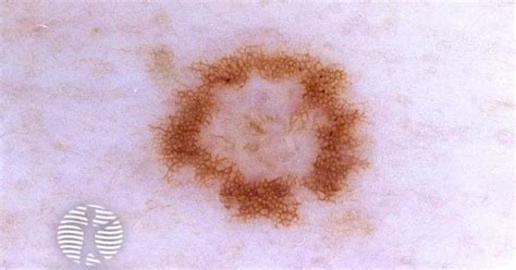 Dermoscopy Central Hypopigmentation Naevus Image
