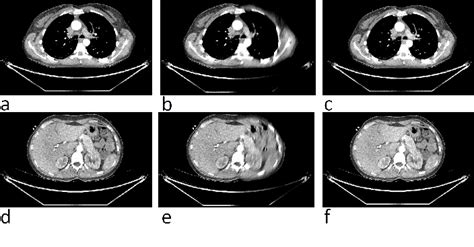 Figure 2 From Model Based Iterative Reconstruction With Spatially Adaptive Sinogram Weights For
