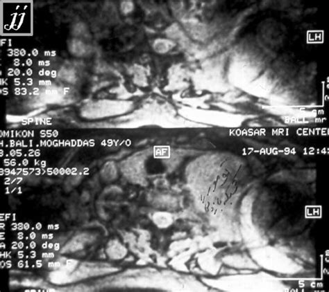 Ent Brachial Plexus Tumor Radioogle