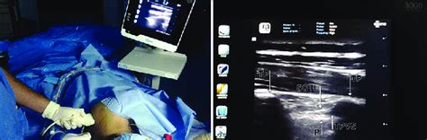 Thoracic Paravertebral Block Procedure A The Needle And Probe Download Scientific Diagram