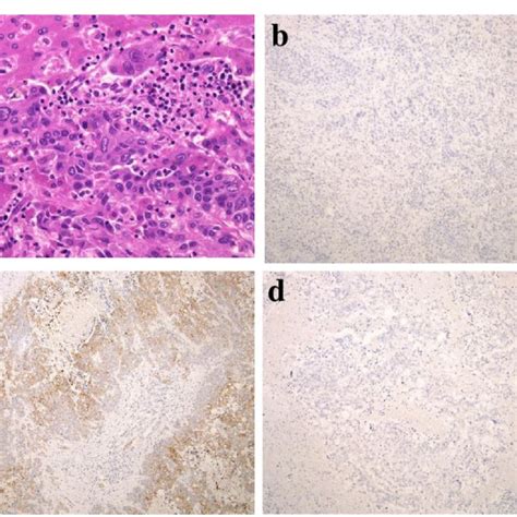 Pdf Intrahepatic Cholangiocarcinoma Coinciding With A Liver