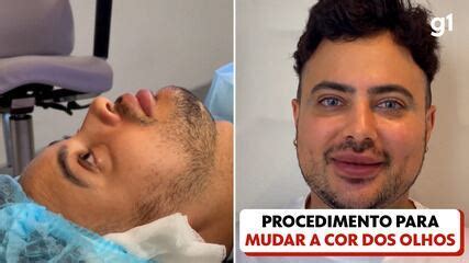 Homem Faz Procedimento Para Alterar Cor Dos Olhos De Forma Permanente E