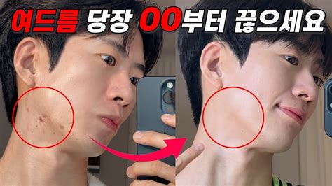 광고 여드름 지금 당장 이것부터 끊으세요 한달만에 여드름 박멸한 방법 Youtube