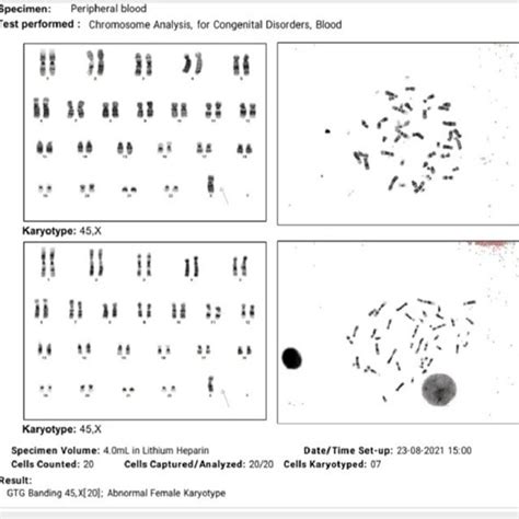 Karyotyping Showing X0 Karyotype Download Scientific Diagram