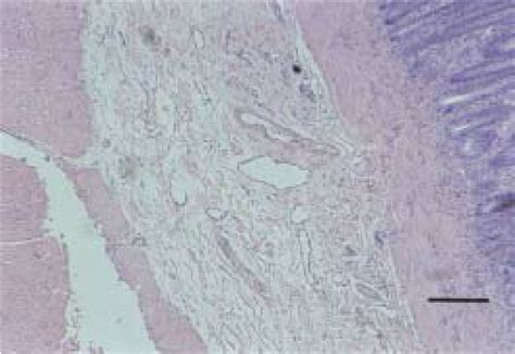 Submucosal Edema And Dilation Of The Submucosal Lymphatic Vessels In Download Scientific