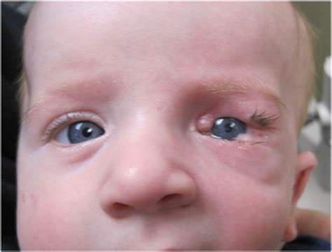 A External Photo Showing Left Upper Eyelid Coloboma Epibulbar Download Scientific Diagram