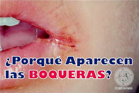 Queilitis Angular ¿porqué Aparecen Las Boqueras Directorio Odontológico
