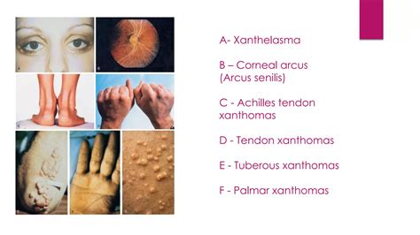 Familial Hypercholestrolemia Pptx