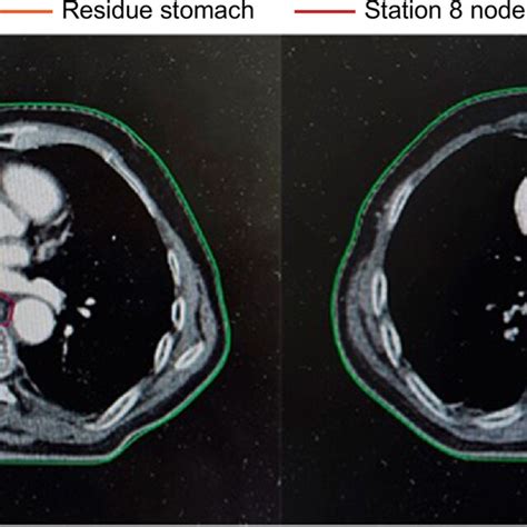 The Area Of 7th Lymph Node Group In Target Delineation Download Scientific Diagram