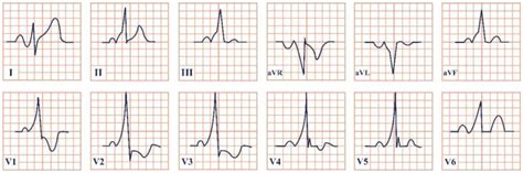 Broad Electrocardiogram Syndromes Spectrum From Common Emergencies To Particular Electrical