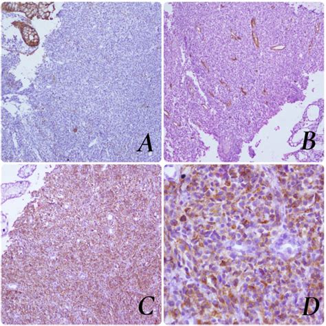 Immunohistochemical Staining Results In Neoplastic Cells Cytokeratin
